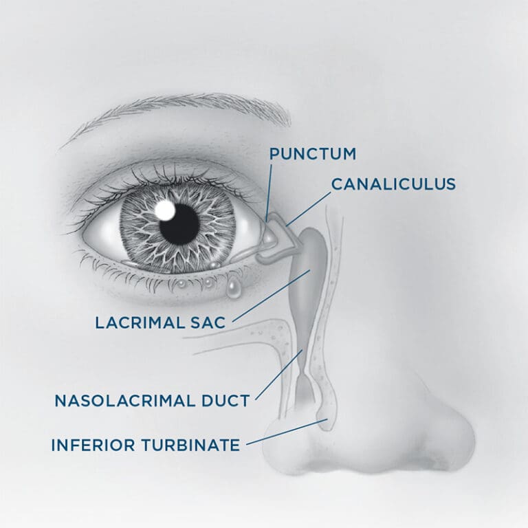 Blocked Tear Ducts – Kids (Probing/Tubes) | Oculofacial Society