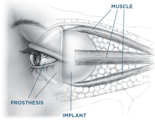 Surgical Eye Removal (Enucleation & Evisceration) | Oculofacial Society