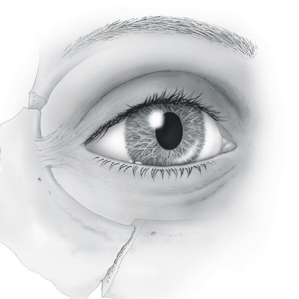Orbital Fractures (Eye Socket Fractures) | Oculofacial Society