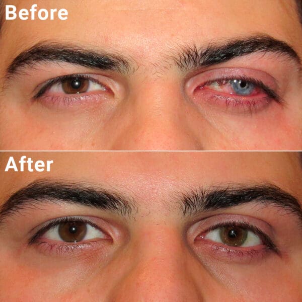 Surgical Eye Removal (Enucleation & Evisceration) | Oculofacial Society